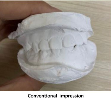 Intraoral Scanning | 口腔内扫描